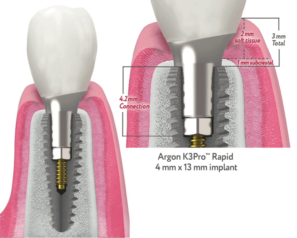 Dental Advantages with Argon Dental | Dental Implant Surgery